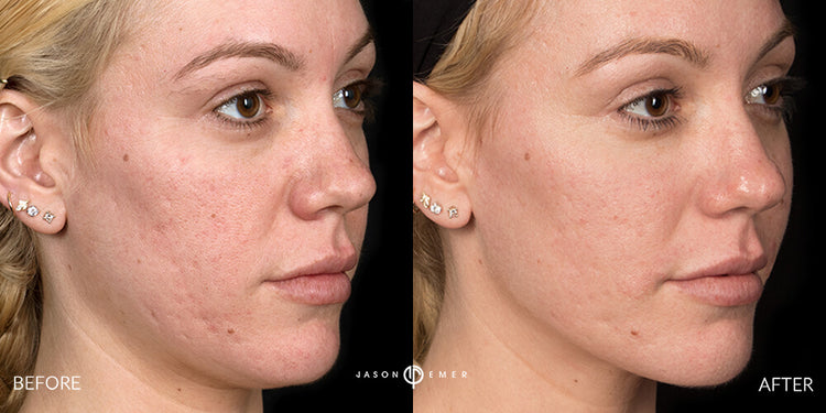 LASER CO2 FRACCIONADO – Dermatophila